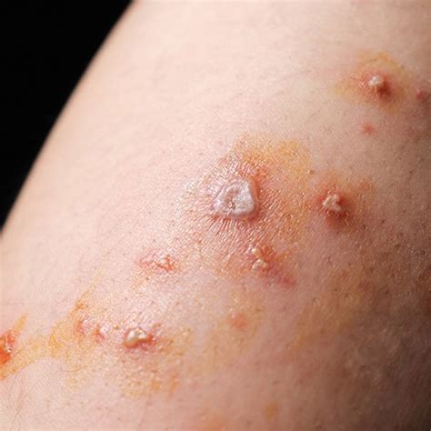 Impetigo Treatment Over The Counter Day Lewis Pharmacy