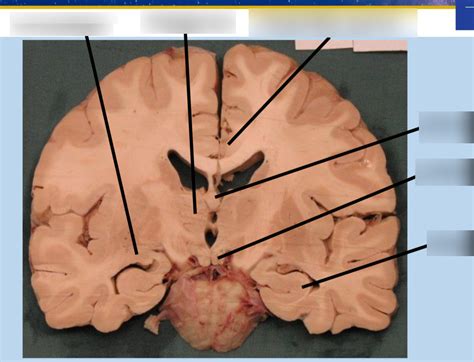 Diagram Of Wk 6 Limbic System Coronal Section Quizlet