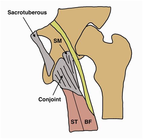Proximal Hamstring Avulsions The Bone School