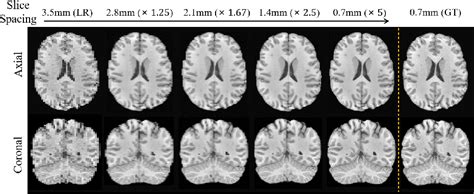 Figure 1 From Arbitrary Reduction Of Mri Inter Slice Spacing Using