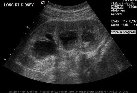 Pyonephrosis Ultrasound