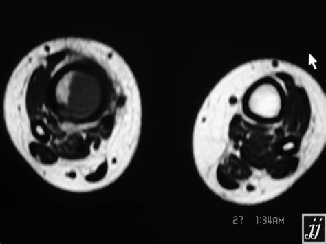 Distal Tibial Cyst Radiopaedia