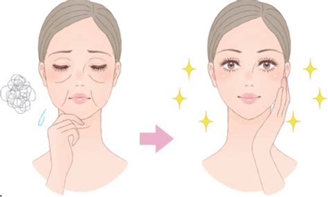 PIPI TURUN Treatment Terbaik Untuk Pipi Yang Turun Klinik Bedah Plastik Queen