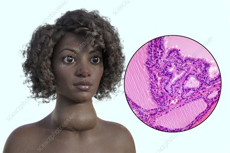 Woman With Enlarged Thyroid And Exophthalmos Illustration Stock Image F043 6087 Science