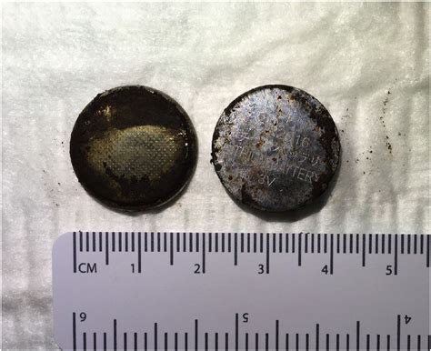 The Batteries Retrieved From The Patient Corrosion Can Be Seen On The