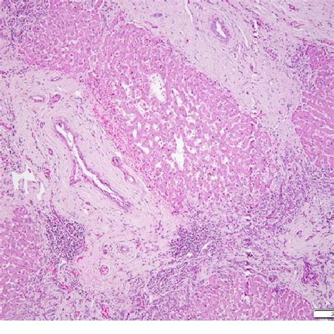 Chronic Cholangitis With Cholangiectasis And Prominent Adenomatous