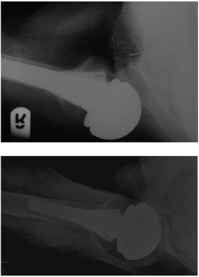 Plain Radiographs A Pre And B Post Revision Surgery For Case 1