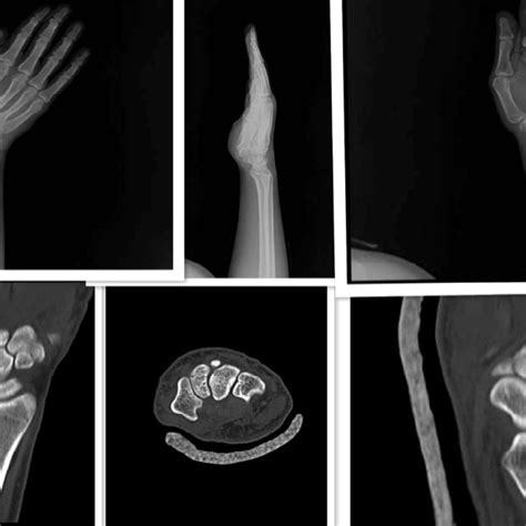 Left Hand Ap Left Hand Scaphoid View Left Hand Lateral Left Hand Download Scientific Diagram
