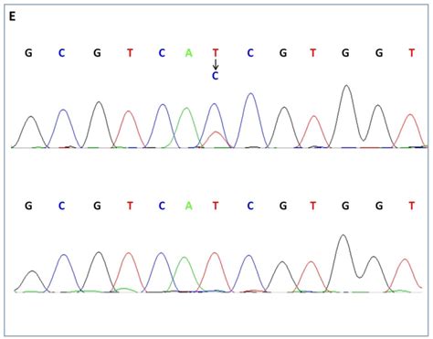 Electropherogram Showing The Identified Pile149thr Variant In Psen2