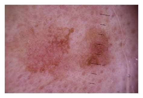 A Lentigo Maligna Dermoscopy Irregular Pigment Pseudonetwork Covers