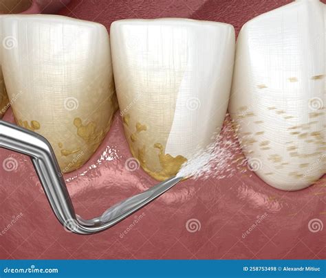 Periodontal Scaling And Root Planing Oral Hygiene And Conventional Periodontal Therapy
