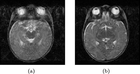 Figure 1 From Correcting Motion Artifacts In Magnetic Resonance Images Semantic Scholar