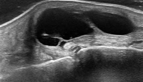Musculoskeletal Joints And Tendons 68 Foot Case 685 Cysts And Ganglia In The Forefoot