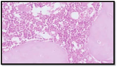Over Decalcification In A Section Of Bone 8 Download Scientific Diagram