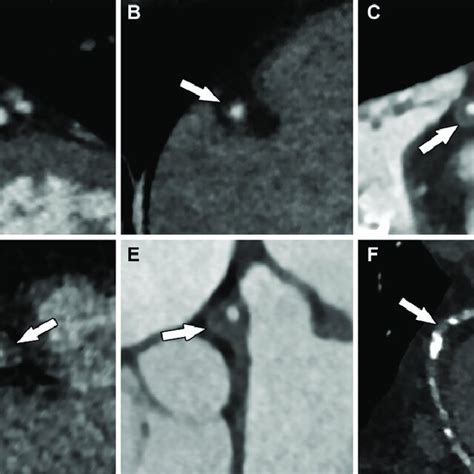 Perfusion Defect In A 54 Yearold Man With Chest Pain Short Axis A