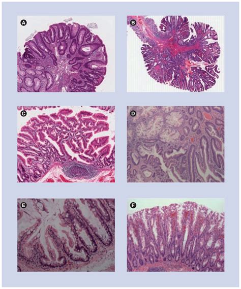 Figure 2 Polyp Histological Subtypes A Traditional Adenoma B Tubulovillous Adenoma C