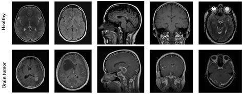 Brain Tumor Detection Using Magnetic Resonance Imaging And Convolutional Neural Networks
