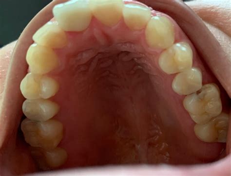 어금니 치아깨짐 지식in