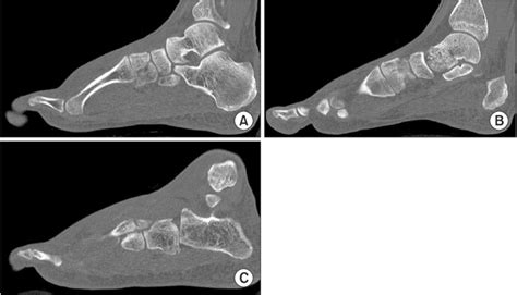 Calcaneocuboid Dislocation