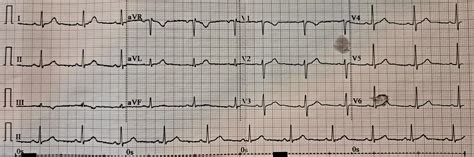 Any Help With This Ecg Please Recg