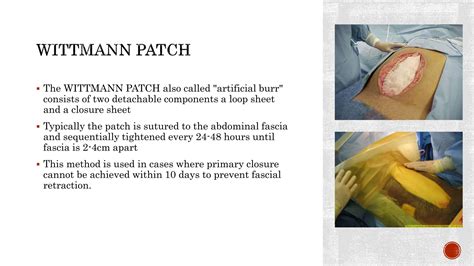Various Temporary Closure Techniques In Open Abdomen Pptx