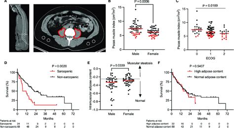 Association Of Sarcopenia With Overall Survival Representative A