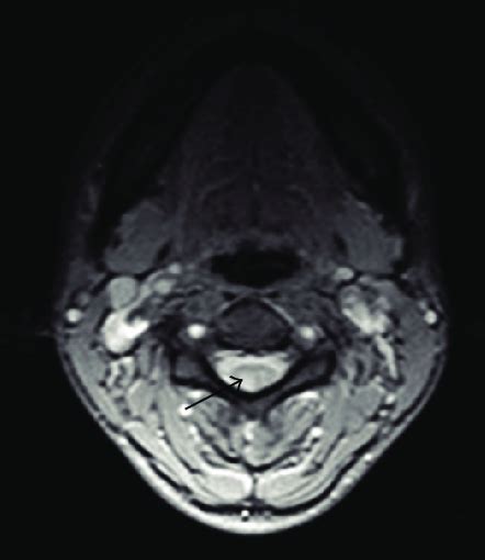Mri 1 5t Axial Section Obtained With Sequence Gre T2 At C4 Level Download Scientific Diagram