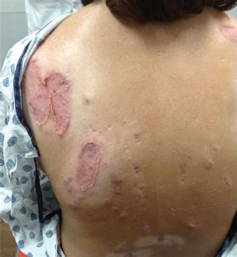 Long Term Remission Of Pyoderma Gangrenosum Acne And Hidradenitis