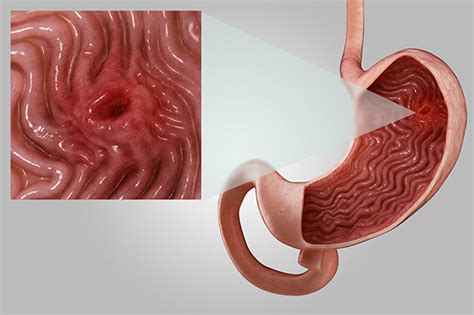 Everything You Need To Know About Stomach Ulcers Dr