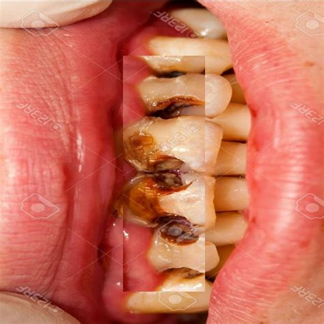 dental caries detection object detection dataset by ziad ghazaly