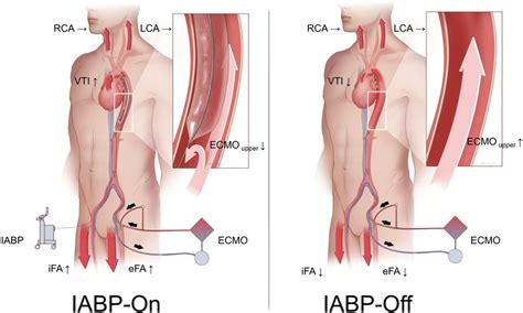 Diagram Of The Impact Of An Intra‐aortic Balloon Pump Iabp On The Download Scientific Diagram
