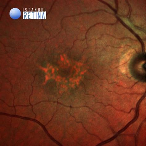 64 Acquired Vitelliform Lesion In The Setting Of Age Related Macular