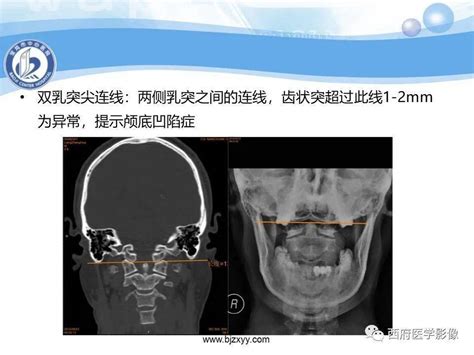 颅底凹陷症的影像诊断与鉴别诊断 畸形