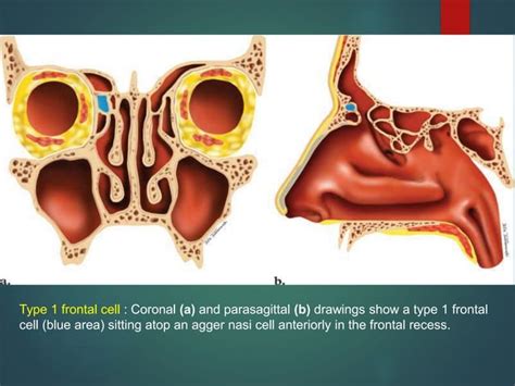 Failed Fess Spectrum Of Ct Findings In The Frontal Recess Ppt