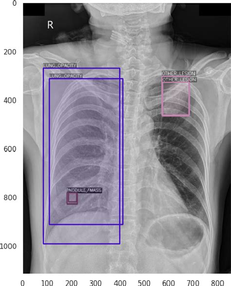 Figure 3 From Chest X Ray Annotation Optimisation Model Using Weighted Boxes Fusion Semantic