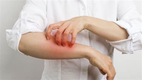 Skin Allergies Beyond The Pill Can We Find A Cure True Or False