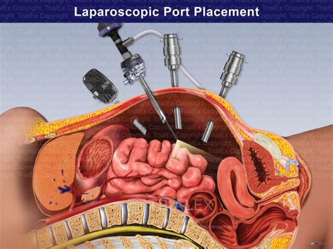 Laparoscopic Port Placement In Abdomen Trialquest Inc