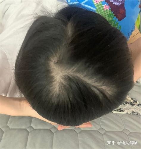 记录我的头发生长米诺地尔 知乎