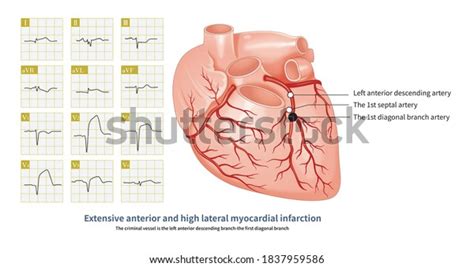 Opening First Diagonal Branch Left Anterior Stock Illustration 1837959586 Shutterstock