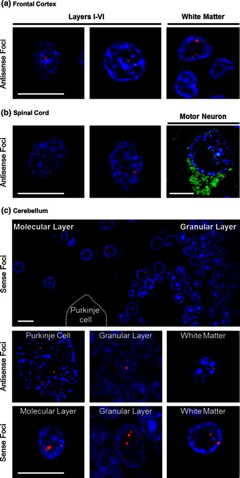 C9orf72 Hexanucleotide Repeat Transcripts Form Nuclear Rna Foci In Download Scientific Diagram