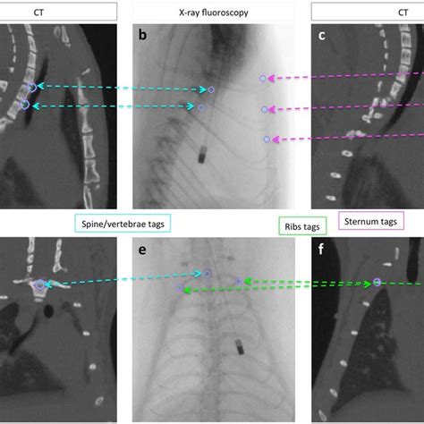 x ray fluoroscopy to ct registration with point matching method