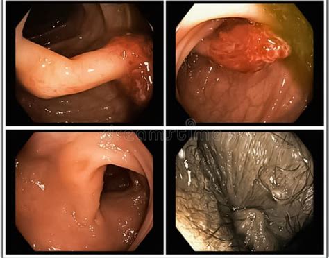 Colon Polyp Endoscope Inside Colonoscopy For Colon Polyps Search Colon Cancer Stock Image