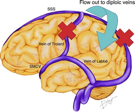 Schematic Representation Of Venous Flow In The Anastomosis And Download Scientific Diagram