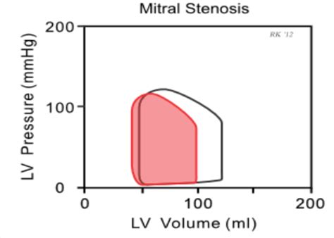 Mitral Stenosis Flashcards Quizlet