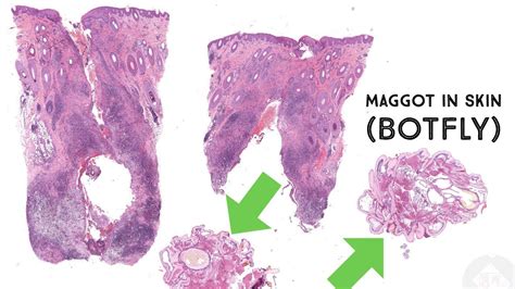 Botfly Fly Larvamaggot In Skin Dermatobia Hominis Tropical Parasite Myiasis Pathology Youtube