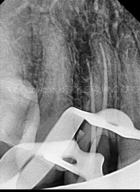 Two Ways Of Warm Vertical Compaction Style Italiano Endodontics