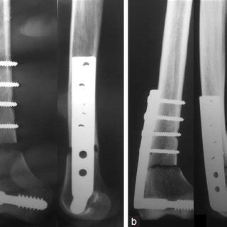 Pdf Biomechanical Comparison Of Dynamic Condylar Screw And Locking Compression Plate Fixation