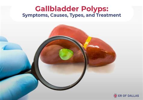 Gallbladder Polyps Symptoms Causes Types And Treatment Er Of Dallas