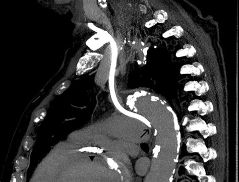 Maximum Intensity Projection Sagittal Reconstructed Contrastenhanced Ct