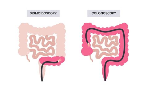 Premium Vector Colonoscopy And Sigmoidoscopy Test Examination And Treatment Of The Large